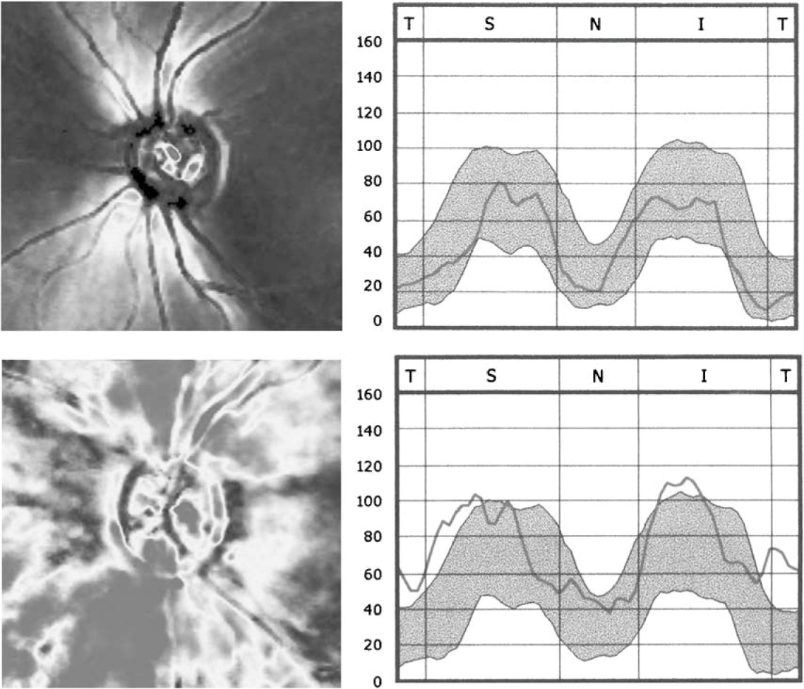 Clinical Characteristics Of Eyes Demonstrating Atypical Patterns In ...
