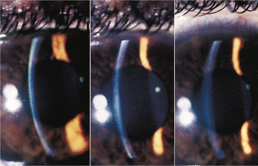 On Focusing The Slit-Lamp: Part I. An Inaccurate Ocular Setting-What Is ...