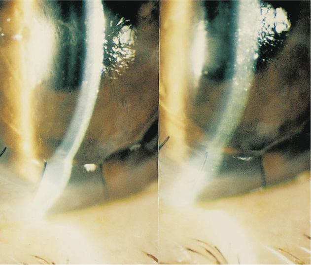 On Focusing The Slit-Lamp: Part I. An Inaccurate Ocular Setting-What Is ...