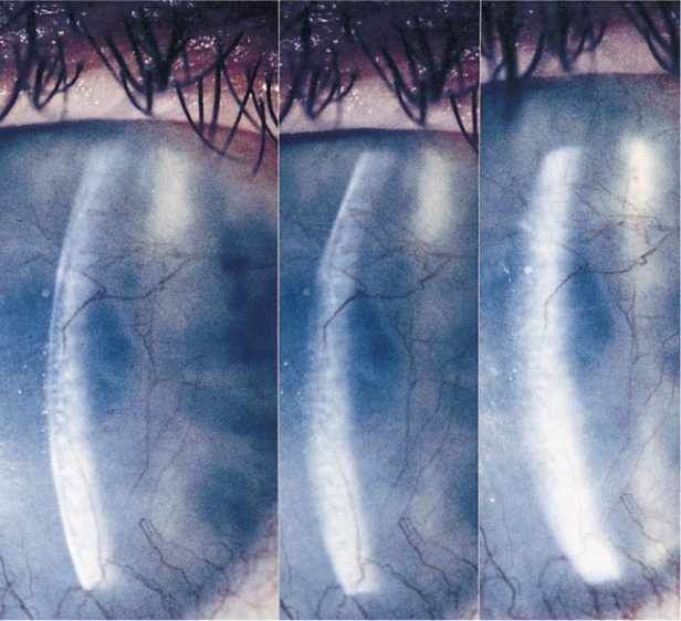 On Focusing The Slit-Lamp: Part I. An Inaccurate Ocular Setting-What Is ...